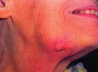 ¿Qué es una fístula dental?