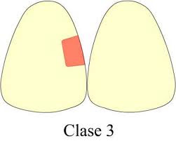 Cavidades de Black: Clase III