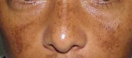 Esteticista-Cosmetóloga: Discromía