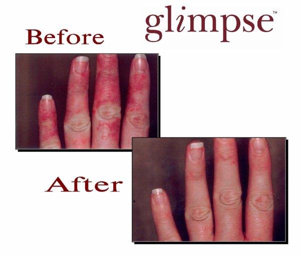 Best Health Advantages and Stuff: Vitamin D Deficiency, My thoughts on ...