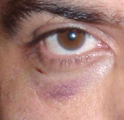 Blog Lunaro: HISTORIA DE UN OJO MORADO (4)