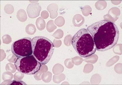 Medical Center: Acute Myeloid Leukemia