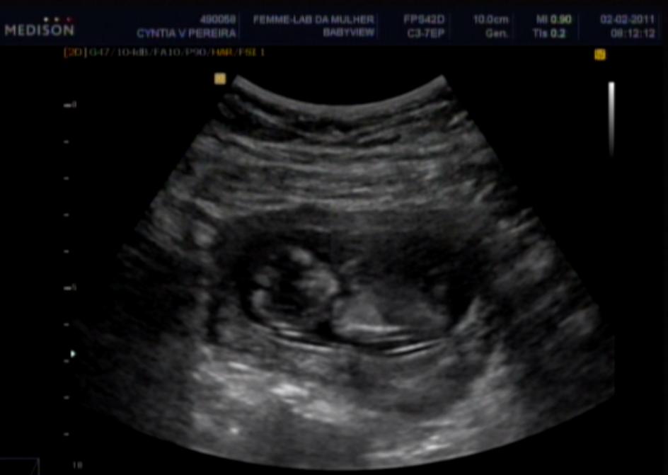 Nossa Gestação: 12 Semanas - US e Visita ao Medico.