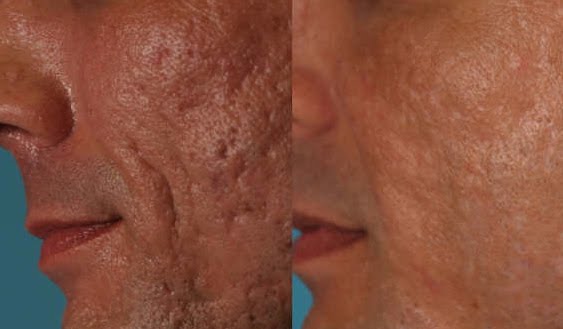 Toque Feminino: Como tratar as cicatrizes do rosto