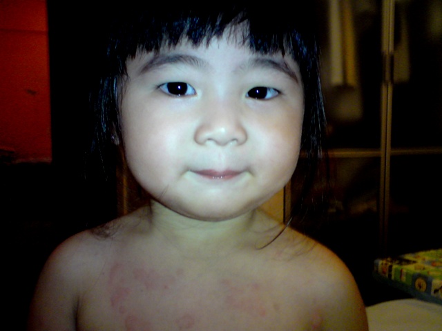 All I Need Is Some T L C Breaking Out In Hives