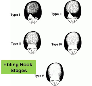 Good Bye Hair Loss - Hair Loss Tips & Advice Online: Female Hair Loss