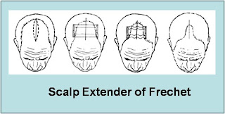 Good Bye Hair Loss - Hair Loss Tips & Advice Online: Scalp Expansion ...