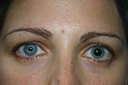 Patient presents with unequal pupils. What is your diagnosis? | little ...