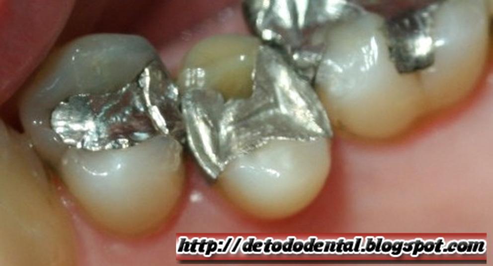 TRATAMIENTOS DENTALES: Debajo de una Amalgama