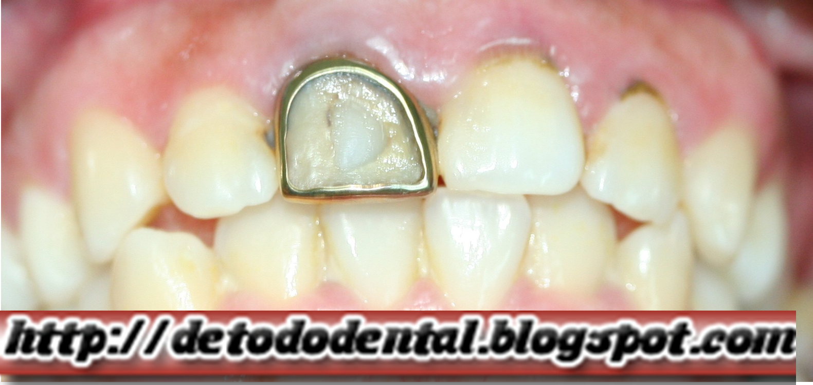 TRATAMIENTOS DENTALES: Corona Fenestrada (OPEN FACE)