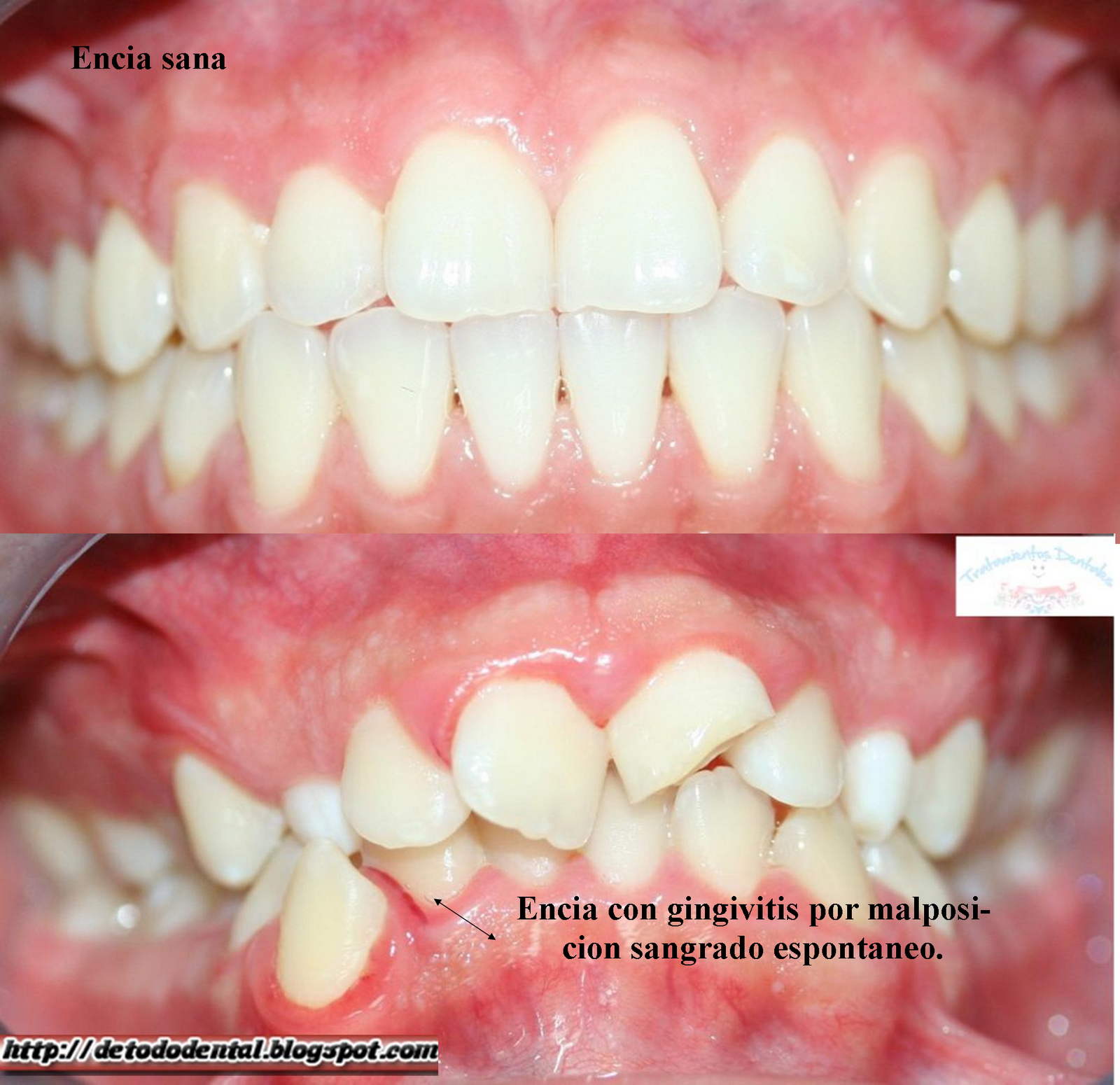 TRATAMIENTOS DENTALES: Y la encía...¿Para qué sirve?