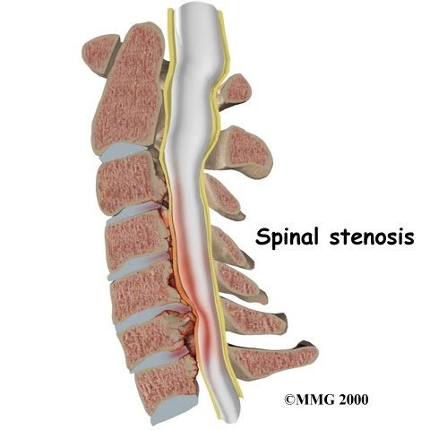 CT/MRI PATHOLOGY BLOG: Thoracic Spinal Stenosis & Thoracic Foraminal ...