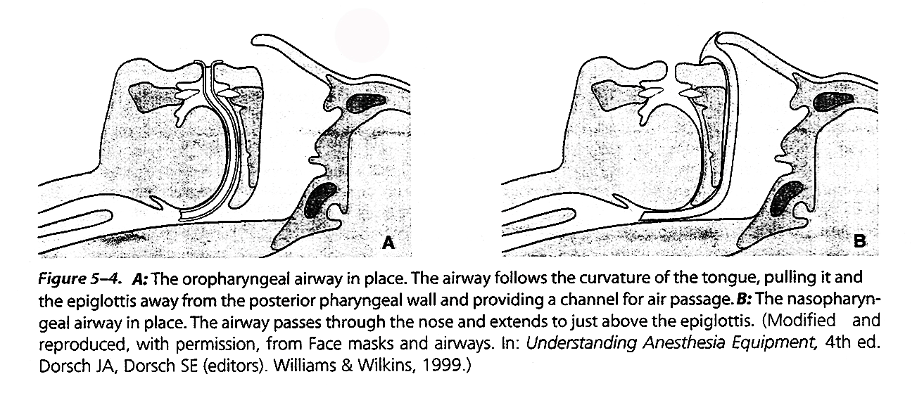 Cucunguk Tutung: Manajemen Jalan Nafas - Alat-Alat