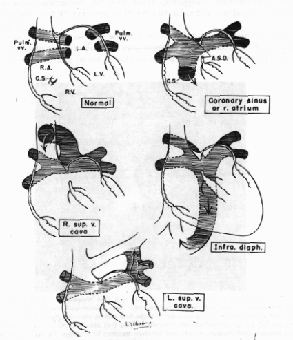 china drifter: Total anomalous pulmonary venous return，TAPVR
