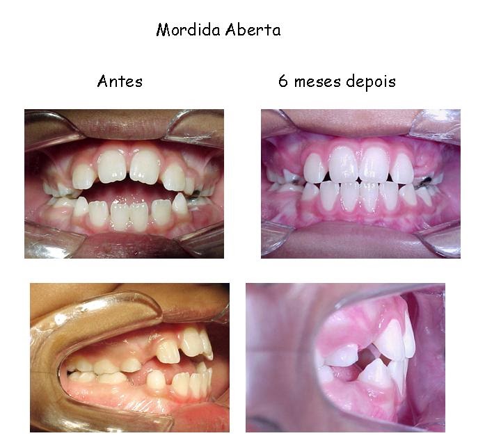 ortoangelica: MORDIDA ABERTA