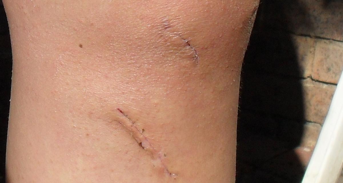 Recovery after ACL Reconstruction: Week 3_Day 4_ Sunday 13 th June