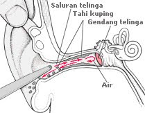 Kesehatan Milik Semua: Sumbatan di Telinga Luar