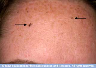 Healthy Life: Skin problems (2) : Sun Damage