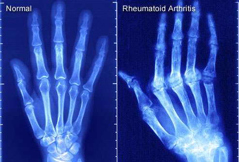 Healthy Life: Rheumatoid Arthritis