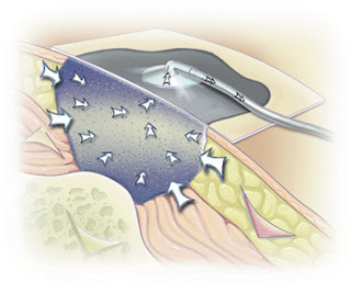 PBM: Week 2 Day 10, Vacuum Assisted Therapy Dressings.
