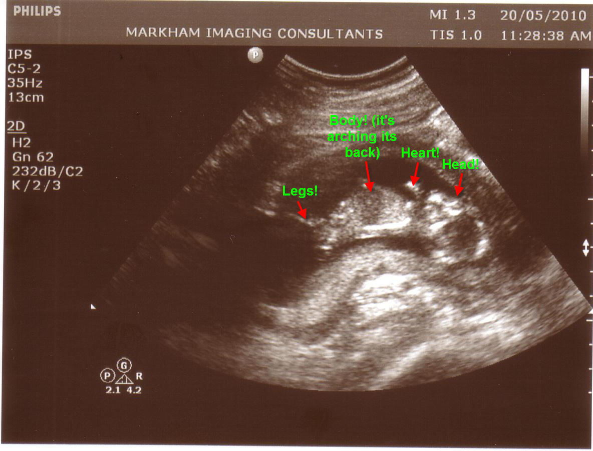 The Next 40 Weeks: A Blog for First Time Moms: 13 Weeks 5 Days