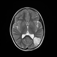 Rob's Radiology: 6-23-2009 Case 1 - DNET