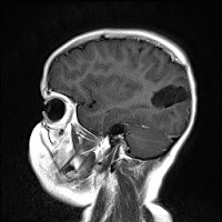 Rob's Radiology: 6-23-2009 Case 1 - DNET