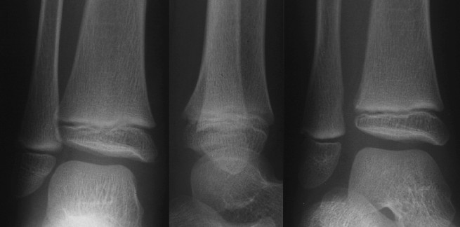 Science&Life: Bone Fractures