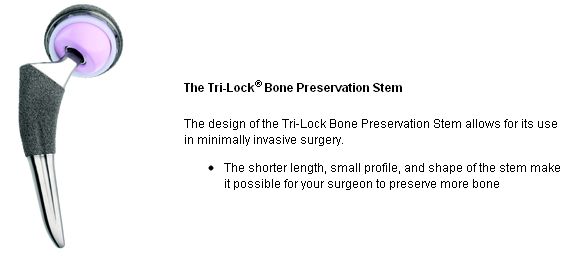 Recharge & Voltz: Ramblings of Introversion: AVN Hip UPDATE: #4 ~ New Hips!