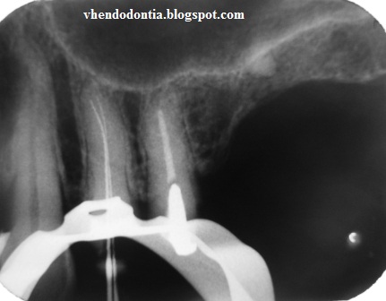 VH Endodontia: Calcificação do canal radicular