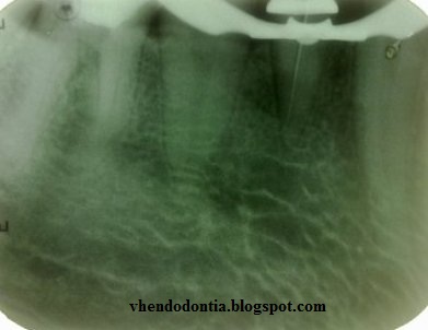 VH Endodontics: Radiographic Apex X Anatomy Apex