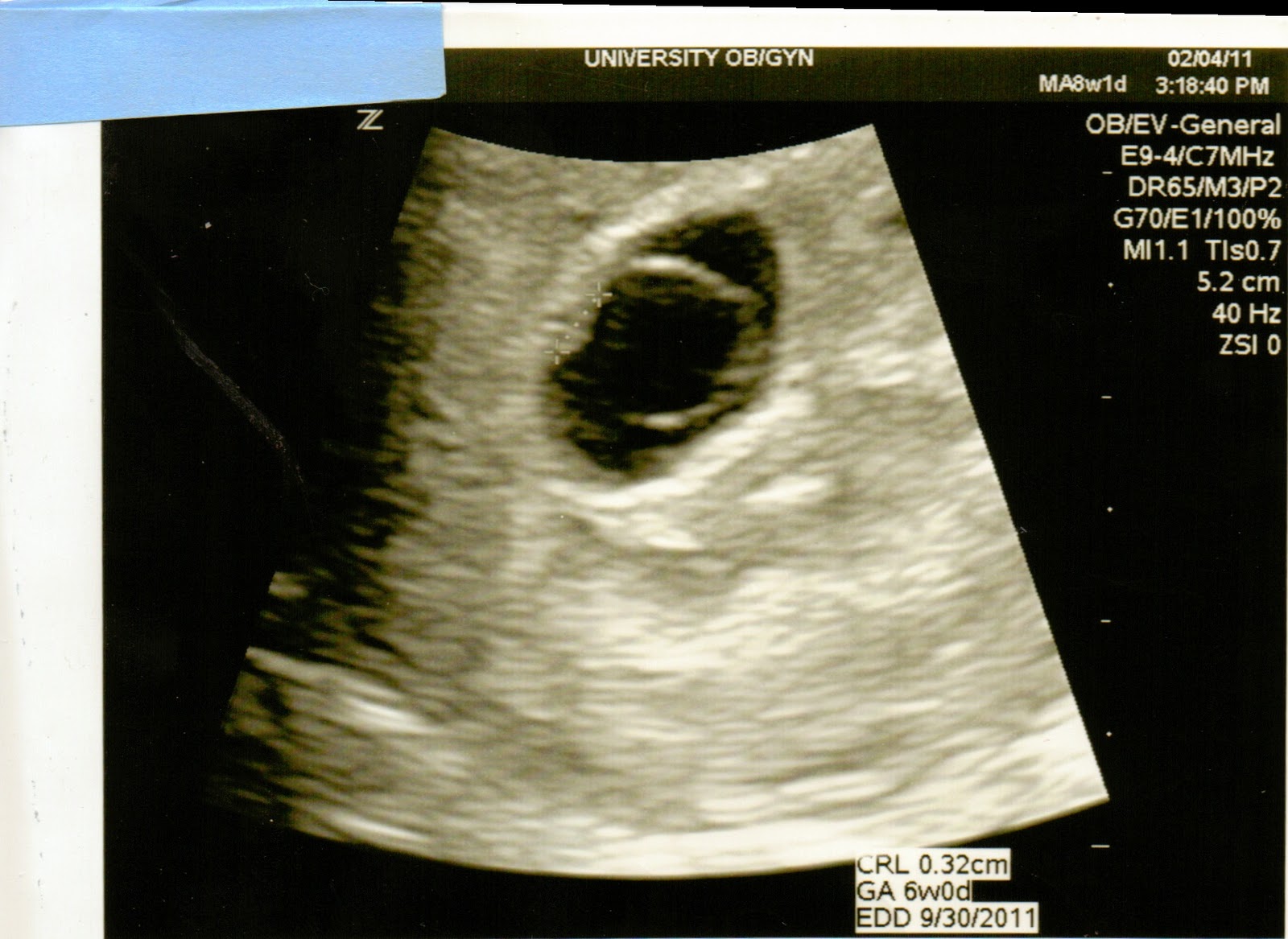 Compromised Fertility 5 Weeks 6 Days Compromised Fertility 5 Weeks 6 Days