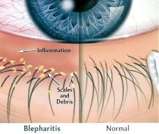 Blepharitis - Chronic Inflammation of the Eyelids | CARRIAZO CENTRO ...