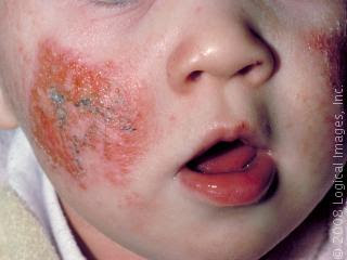 Dermatitis Atopik | Ini Langkahku ...