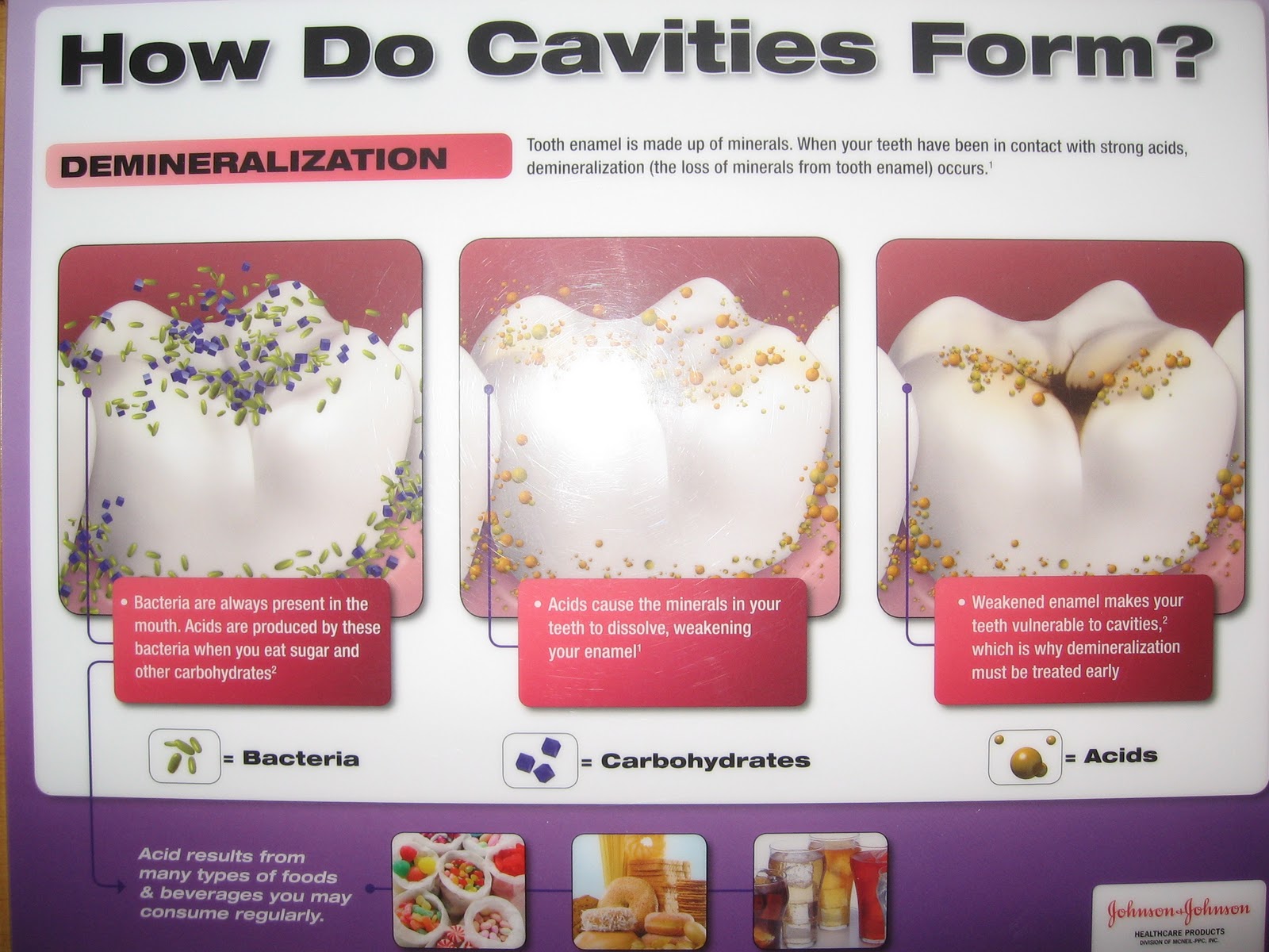 Dirty Mouth:: Cavities - Why?