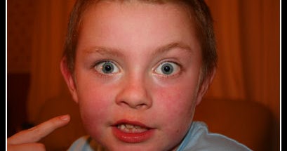 A Creative Muddle: Slapped Cheek Disease!