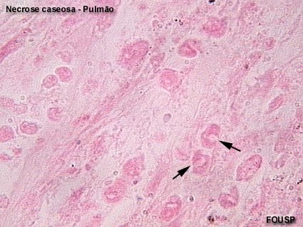 Patologia - Fisioterapia: Necrose