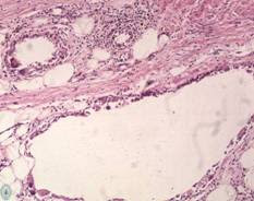 Patologia - Fisioterapia: Necrose