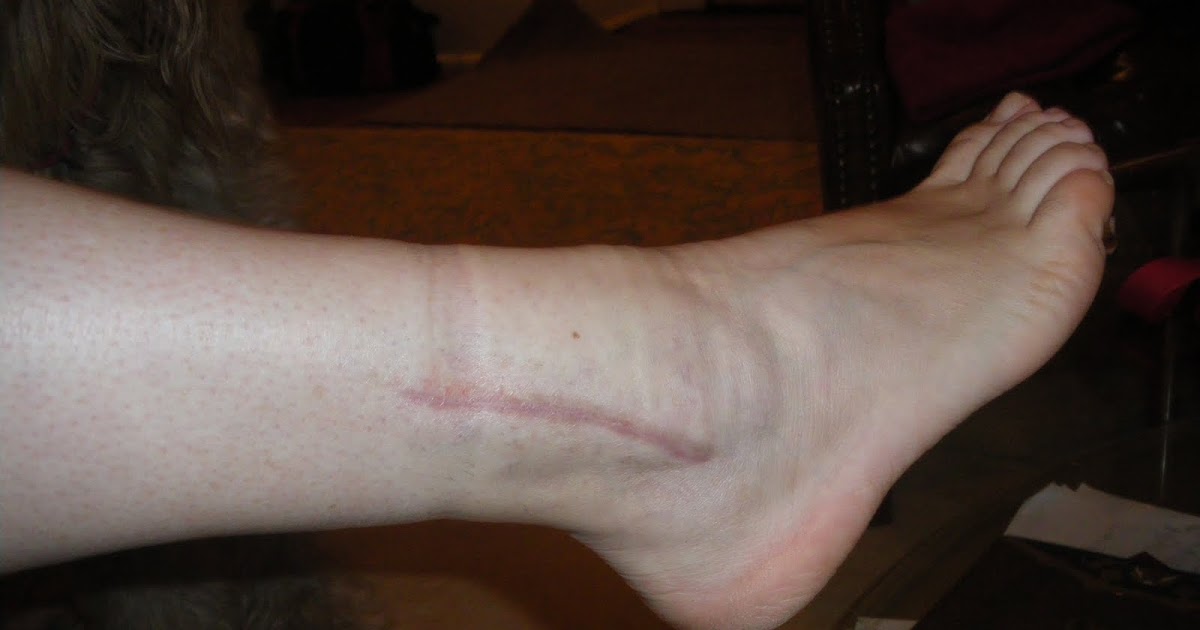 one leg shorter than the other after fractured fairy