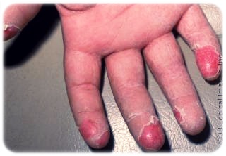 F A R I E Z A 's: Scarlatina (Scarlet Fever)