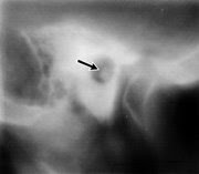 Radiography: Linear Tomography