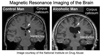 :::intoxicated colourfully:::: The Neurophysiological Effect of Alcohol ...