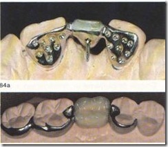 les bridges collés ~ LES COURS DENTAIRE