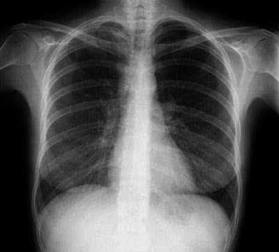Técnicas Radiológicas y Avances: RX Tórax Pa