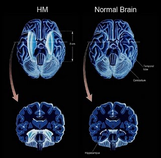 Hjerne Blog: Historien om H.M.