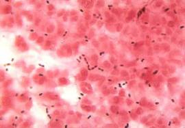 Sinusitis Understood: Infectious Causes (Viruses, Bacteria, Fungi) of ...