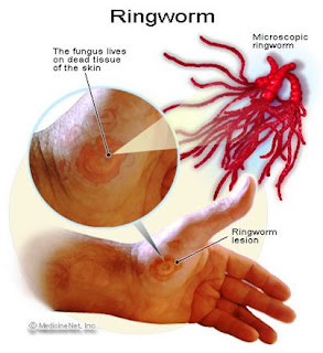What Is Ringworm Treatment | Smart Blog