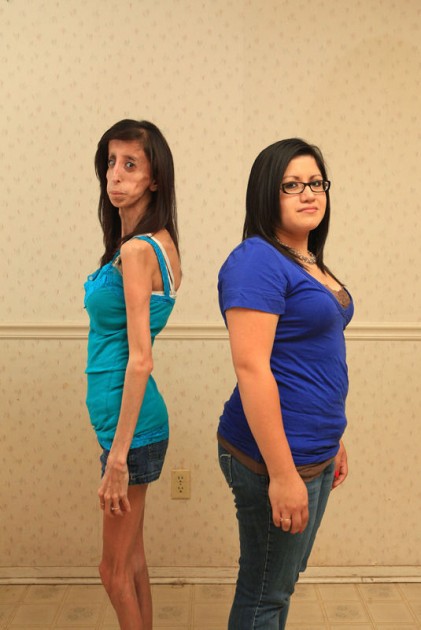 teraka randriantsoa: Lizzie Velasquez Femme la plus maigre du monde