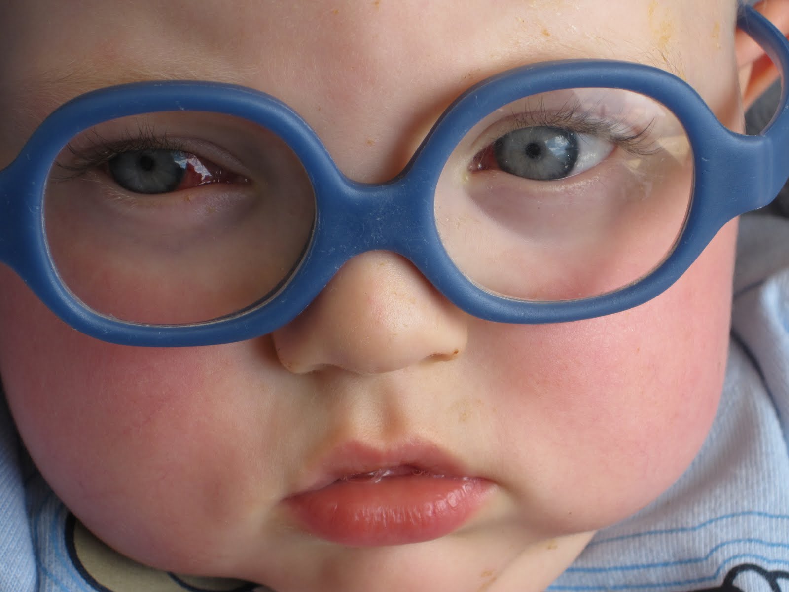 Bryce Alexander Moline: Post Surgery...eyes