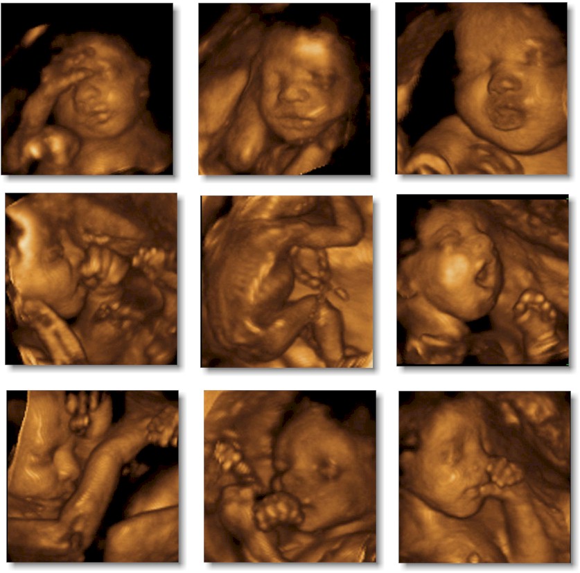Naielynn 2D 3D 4D Baby Scan naielynn-2d-3d-4d-baby-scan